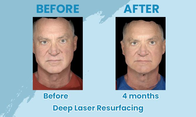 Laser Skin Resurfacing | Advanced Image Med Spa | Glendale, AZ