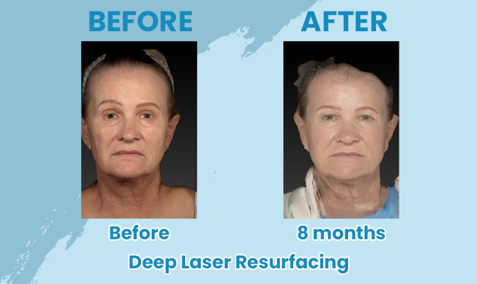 Laser Skin Resurfacing | Advanced Image Med Spa | Glendale, AZ